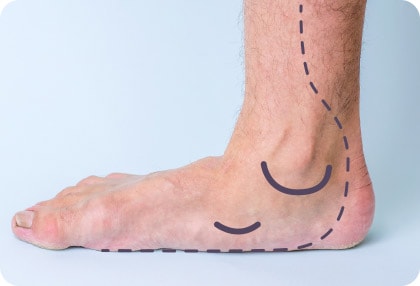 New Fuzion AFO Strut Options - Orthomerica Products, Inc.